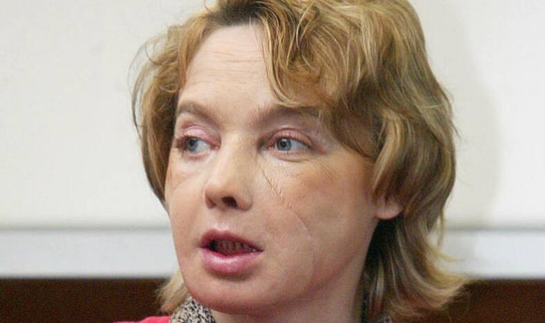 Isabelle Dinoire, who received world’s first face transplant dies at 49 ...