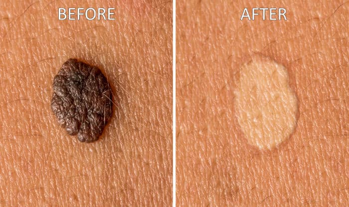 How to get rid of moles: 9 natural home remedies to remove moles from ...