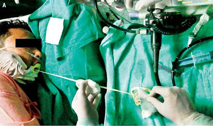 Watch: Doctors pull out 6 feet worm from man’s intestine | India.com