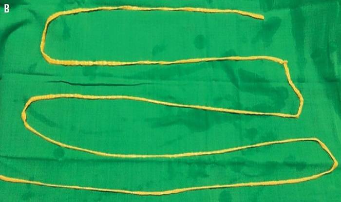 Watch: Doctors pull out 6 feet worm from man’s intestine | India.com