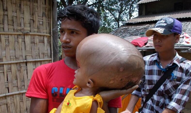Roona Begum, whose head had swollen 3 times its normal size, dies ...