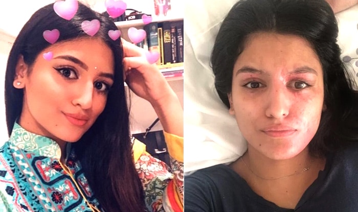 Acid Burn Victims Before And After