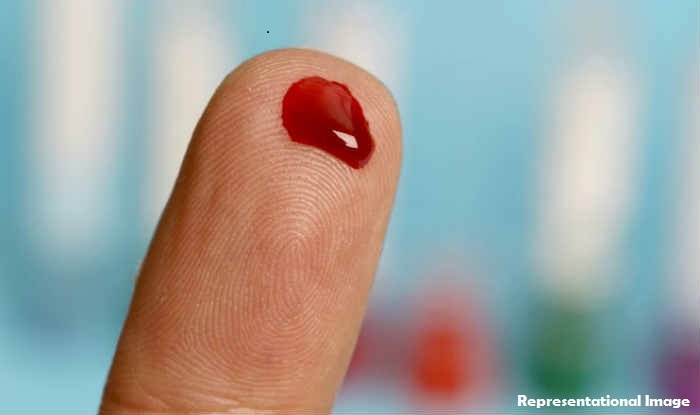 Woman Who Sweats Blood Leaves Doctors Puzzled: Hematidrosis Patient ...