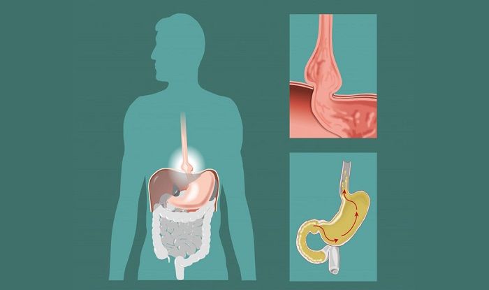 All You Need to Know About Gastroesophageal Reflux Disease
