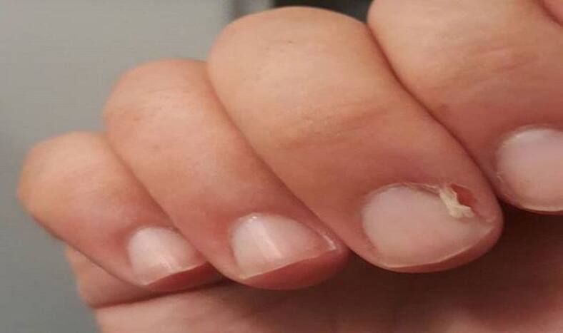 Dip, Clip, Disinfect, And Moisturize Your Hangnails to Get Rid of Pain