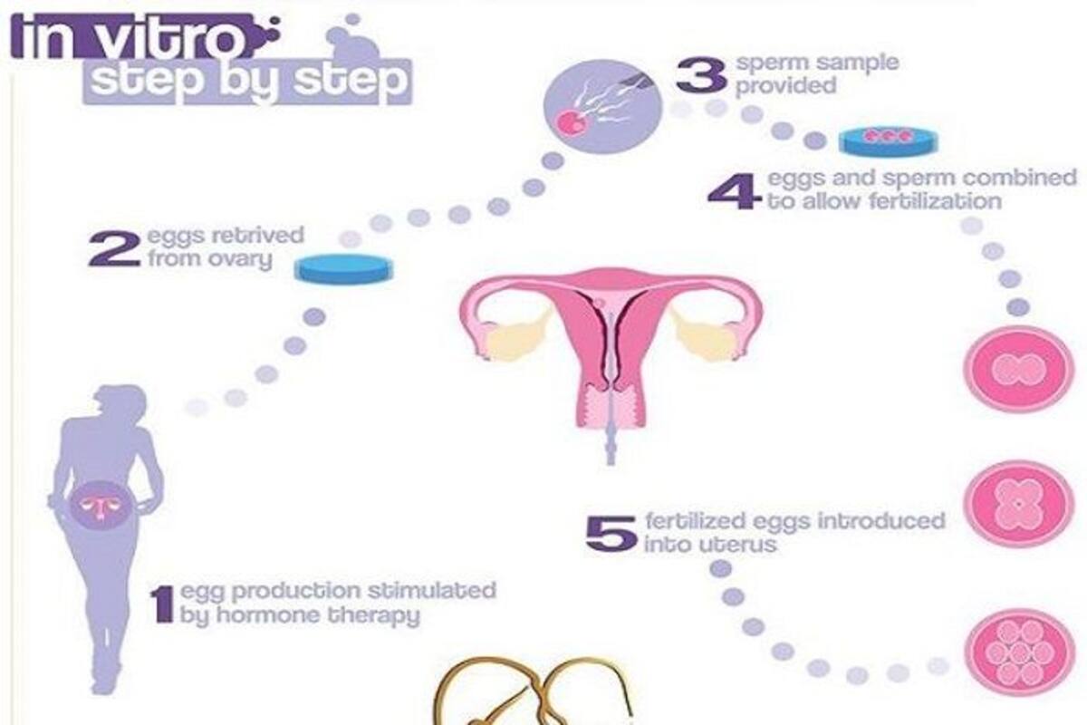In Vitro Fertilization Process