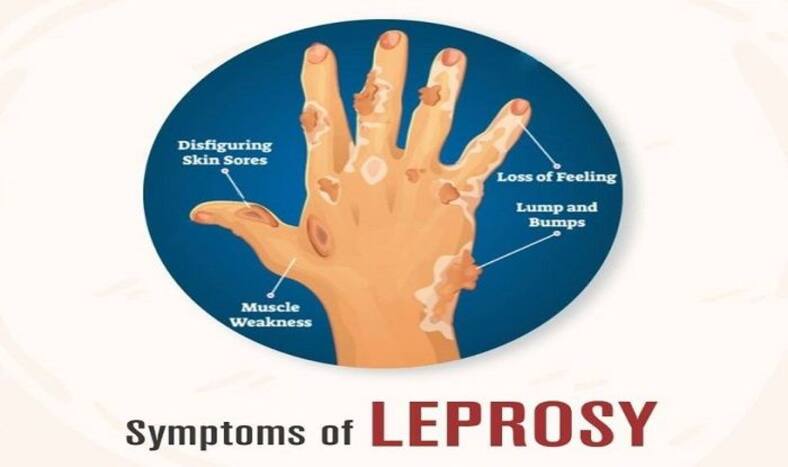 Leprosy: Top Myths And Misconceptions Surrounding The Condition, Busted ...