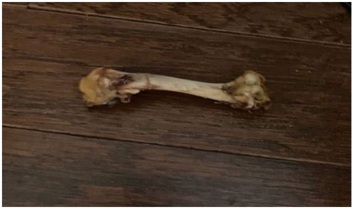 This Woman Went 14 Years With a Chicken Bone Stuck in Her Lungs | India.com