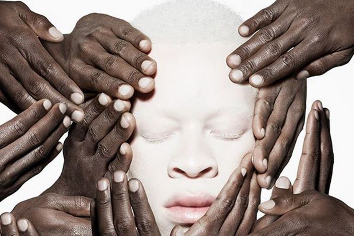 International Albinism Awareness Day 2020: History, Significance of The ...