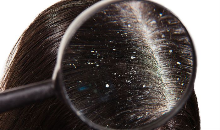 Here is How to Use Your Hair Oil to Bid Adieu to Stubborn Dandruff Here is How to Use Your Hair Oil to Bid Adieu to Stubborn Dandruff