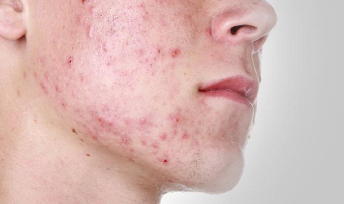 Home Remedies For Acne: Here is How to Get Rid of This Common Skin Problem