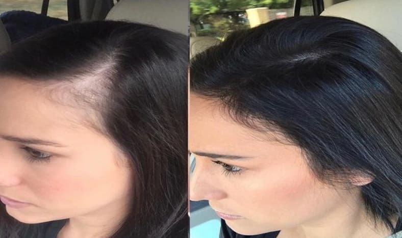 Experiencing Temple Hair Loss? Treat it With These Simple Natural Remedies