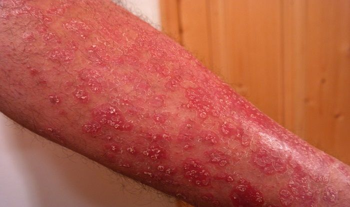 Psoriasis: All You Need to Know About This Chronic Skin Disease