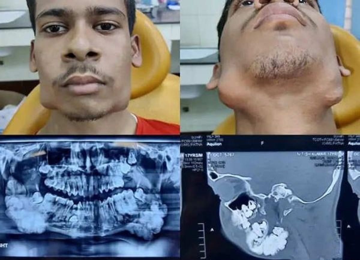 Bihar Teenager Nitish Kumar Gets 82 Teeth Removed in Rare Surgery