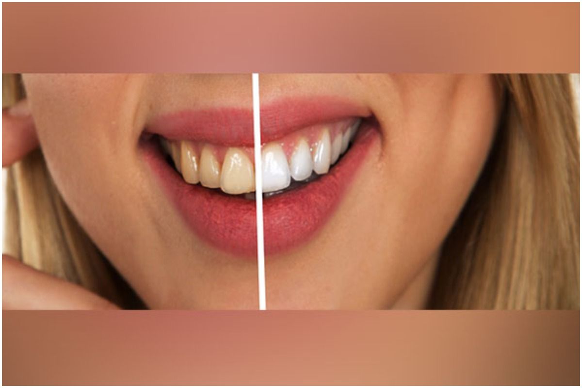 7 Food Items Responsible for Causing Yellow Teeth And Why You Should ...
