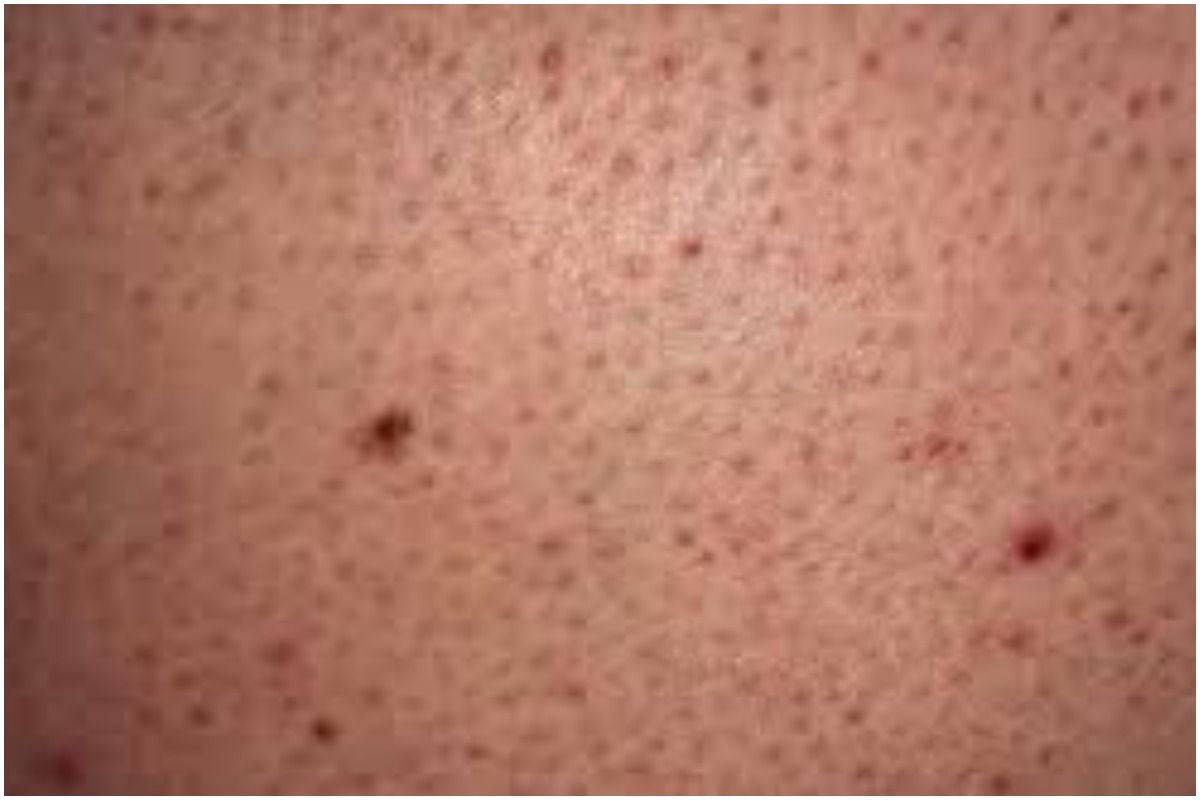 Chicken Skin Treatment Tips: चिकन स्किन से पाना चाहते हैं छुटकारा तो ...