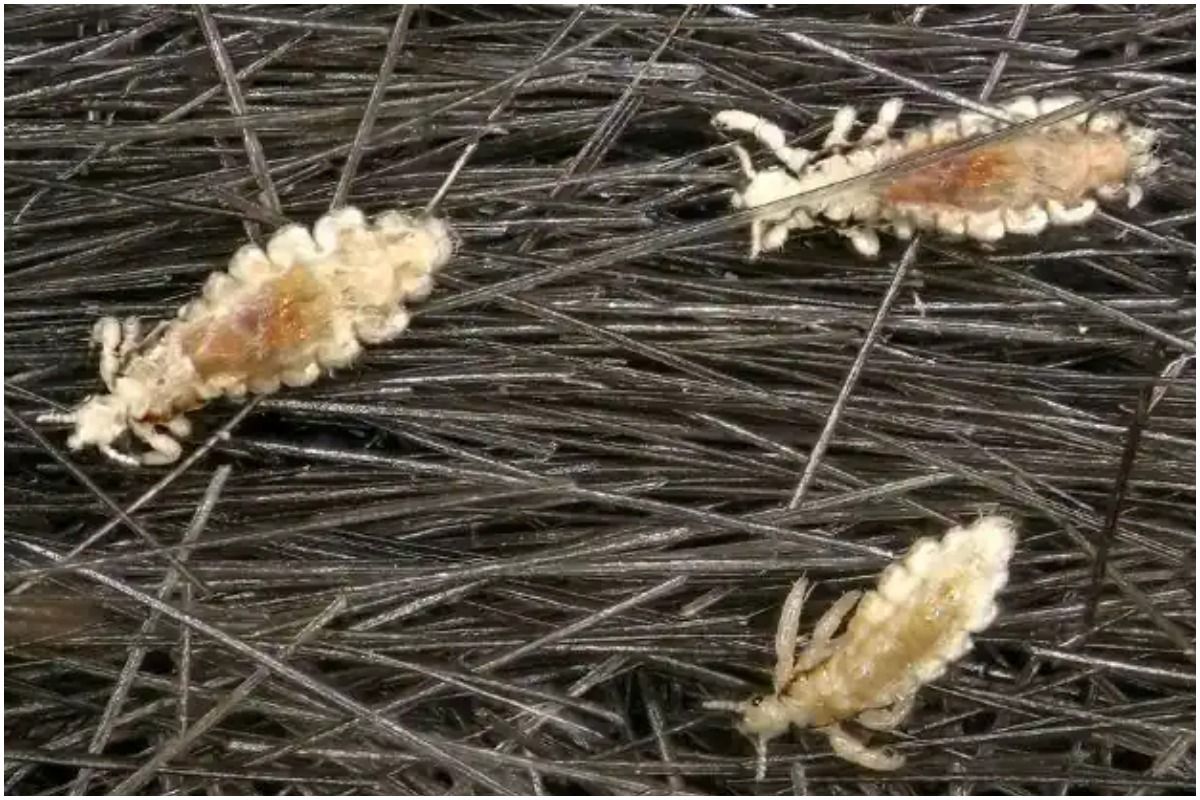 Lice In Rainy Season: बारिश के मौसम में बच्चों के सिर में पड़ गए हैं ...
