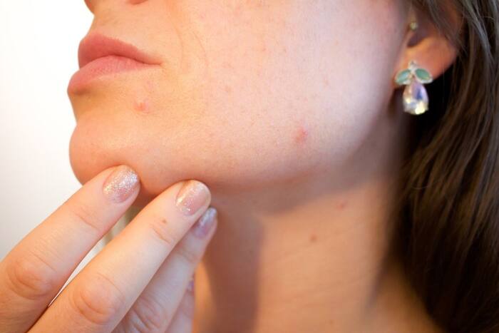 Pimple Marks Cure: Try These 5 Easy Home Remedies