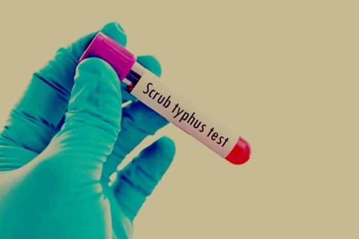 What is Scrub Typhus And Why This Virus is Found in Rural Pockets ...