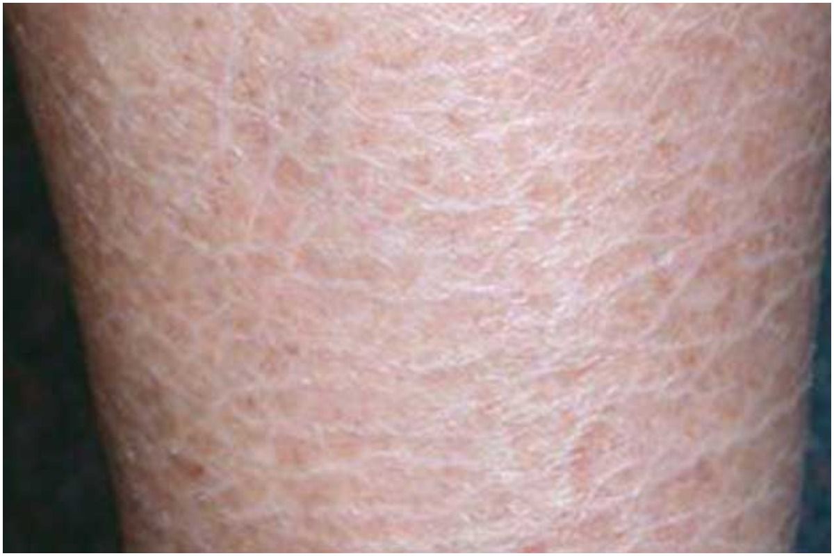 Fish Scales Skin In Winter: सर्दियों में आपकी भी हो जाती है मछली जैसी ...