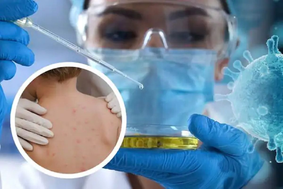 Monkeypox In India Samples Of 5 year Old With Complaints of Itch ...