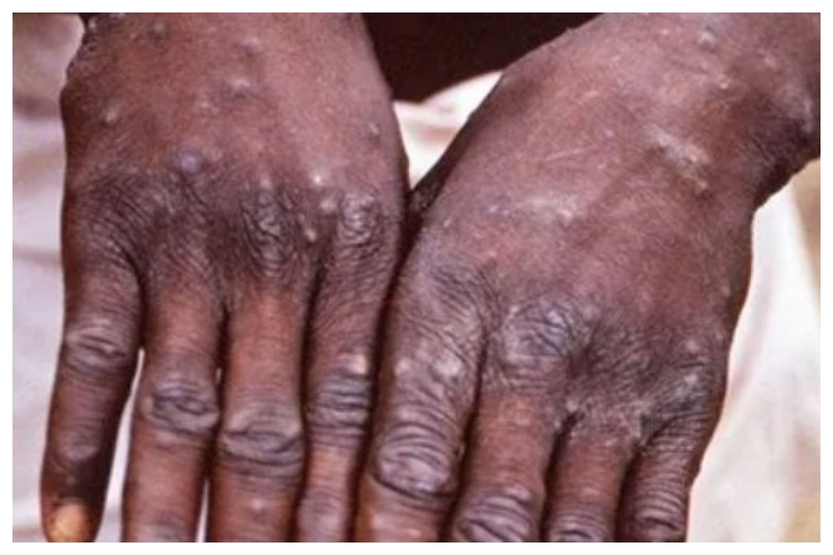 Monkeypox: Canada Confirms 58 Cases, Warns ‘Anyone Could Get Infected ...