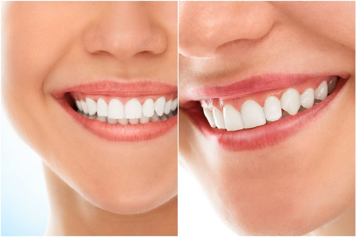 मजबूत दांतों के लिए कीजिए बस ये काम, बुढ़ापे तक हिलेंगे नहीं हिलेंगे