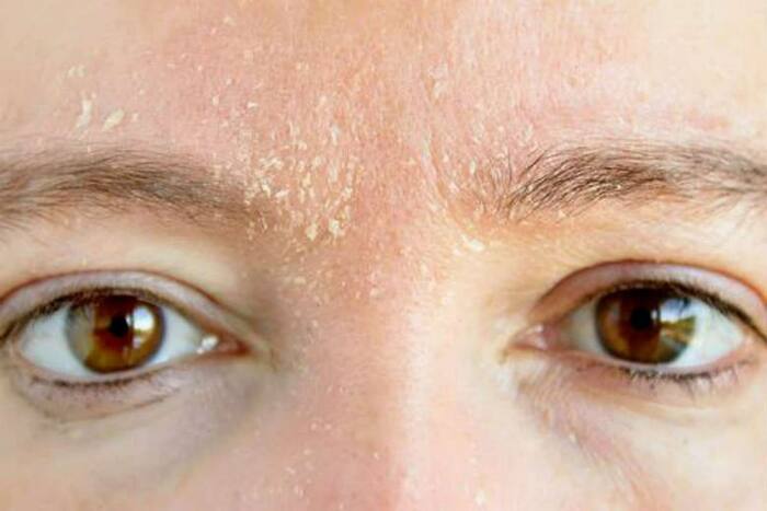 Eyebrow Dandruff is a Real Thing| Know How it Occurs And Ways to Treat ...