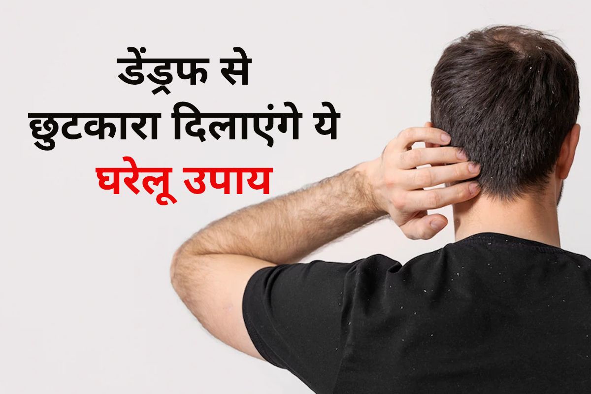 Dandruff Home Remedies : जिद्दी रूसी से हैं परेशान, तो ये 12 घरेलू उपाय ...