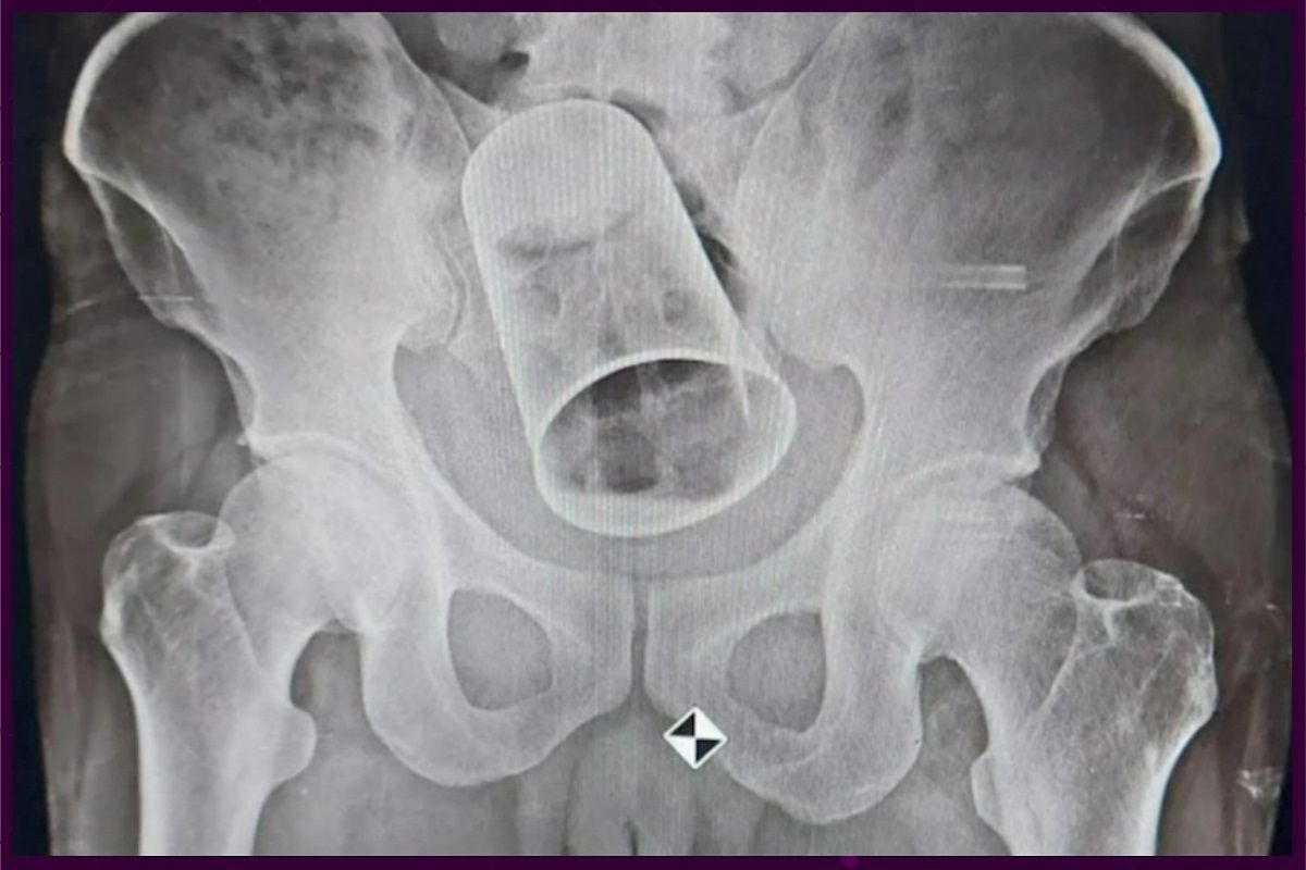 Steel Glass Inserted In Mans Rectum Surgically Removed After 10 Days 