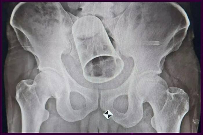 Steel Glass Inserted In Mans Rectum Surgically Removed After 10 days