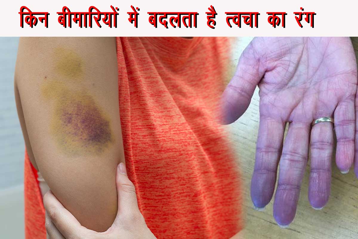 स्किन का कलर बदलना आपके अंदर पनप रही किस बीमारी की ओर इशारा करता है? जानिए