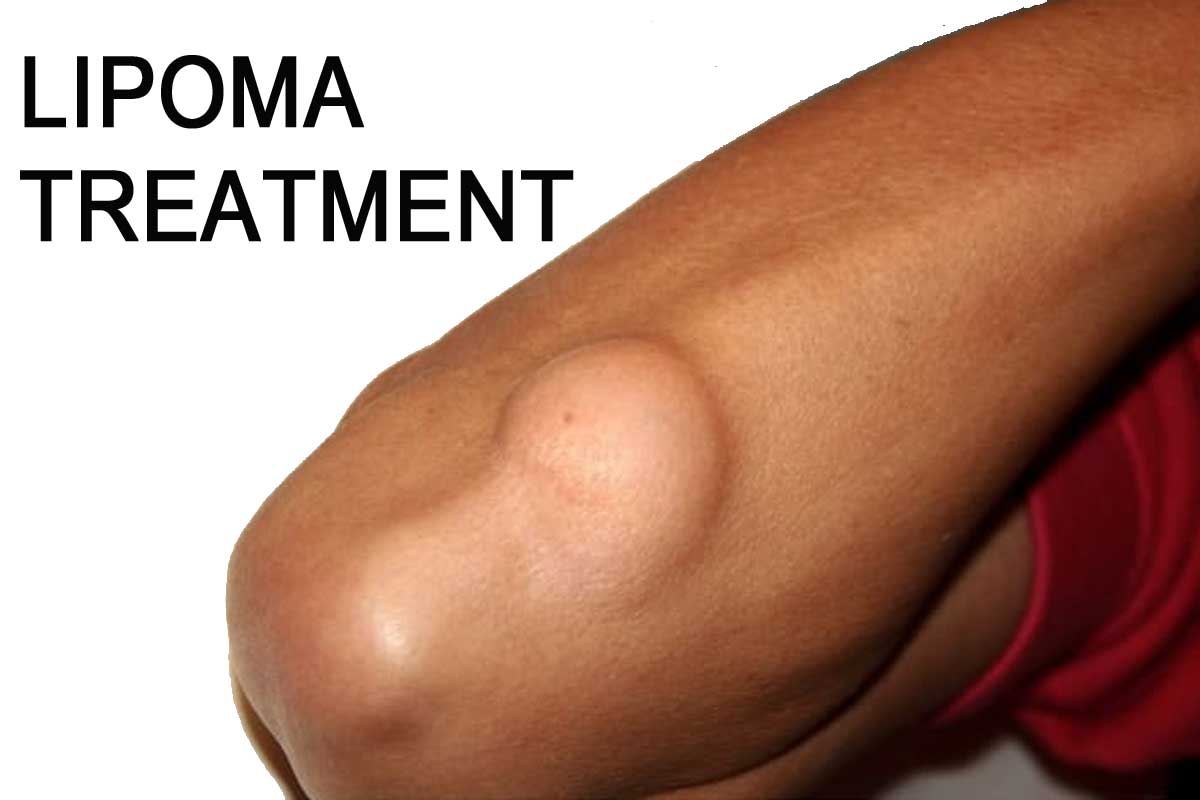 Lipoma Treatment: क्या आपके शरीर में भी हैं ऐसी चर्बी की गांठें, तो जानें उनसे छुटकारा पाने का ...