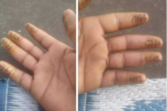 Fingerprint Surgery How a Rs 25000 Operation Helped Deportees Re Enter ...