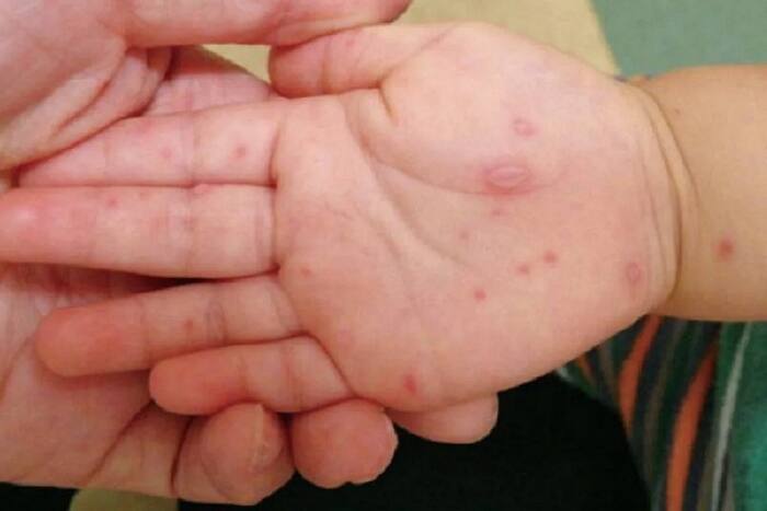 HFMD Alert : लहान मुलांना HFMD चा धोका, हात पायांवर फोडांसह येतोय ताप ...