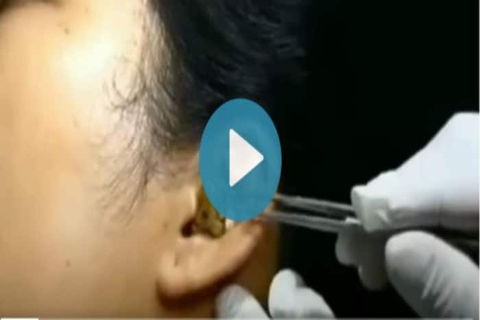 Viral Video: Snake Stuck In Woman