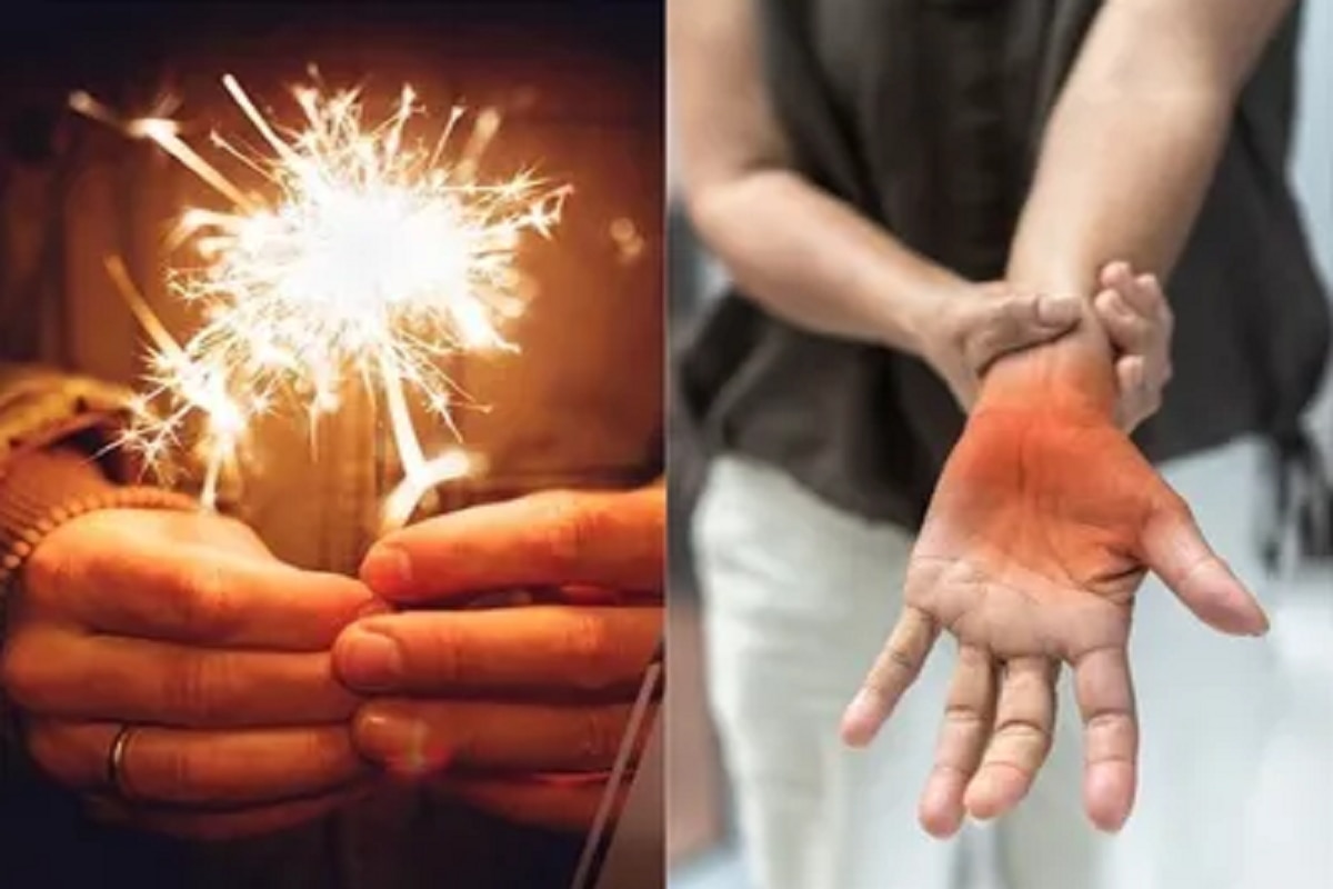 Diwali Safety Tips: फटाके फोडताना हाताला भाजले तर ट्राय करा हे घरगुती ...
