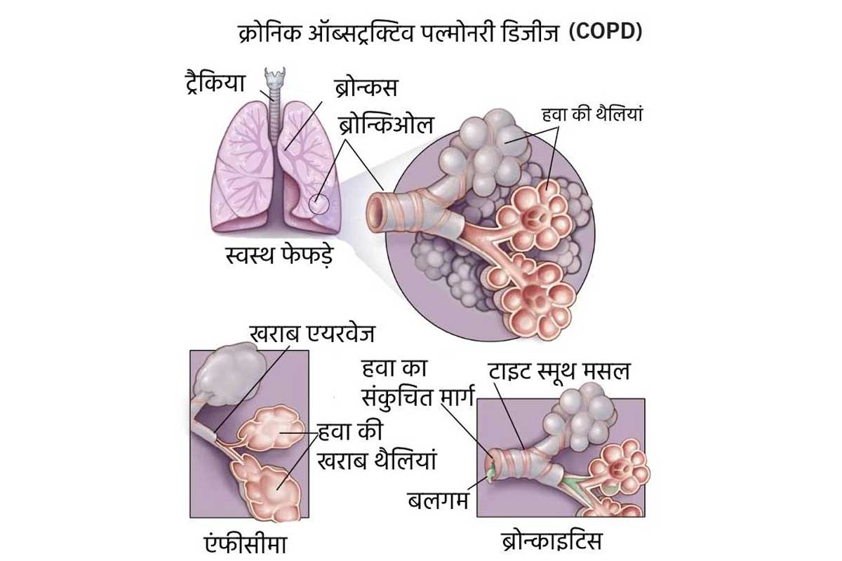 World COPD Day: जानिए सीओपीडी क्या है, इसके लक्षण, कारण और इलाज