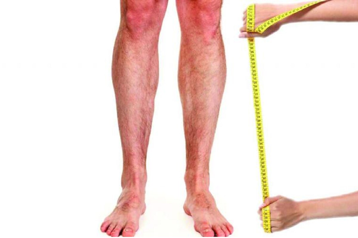 Leg Lengthening surgery : 68 वर्षीय व्यक्तीने शस्त्रक्रियेद्वारे वाढवली ...