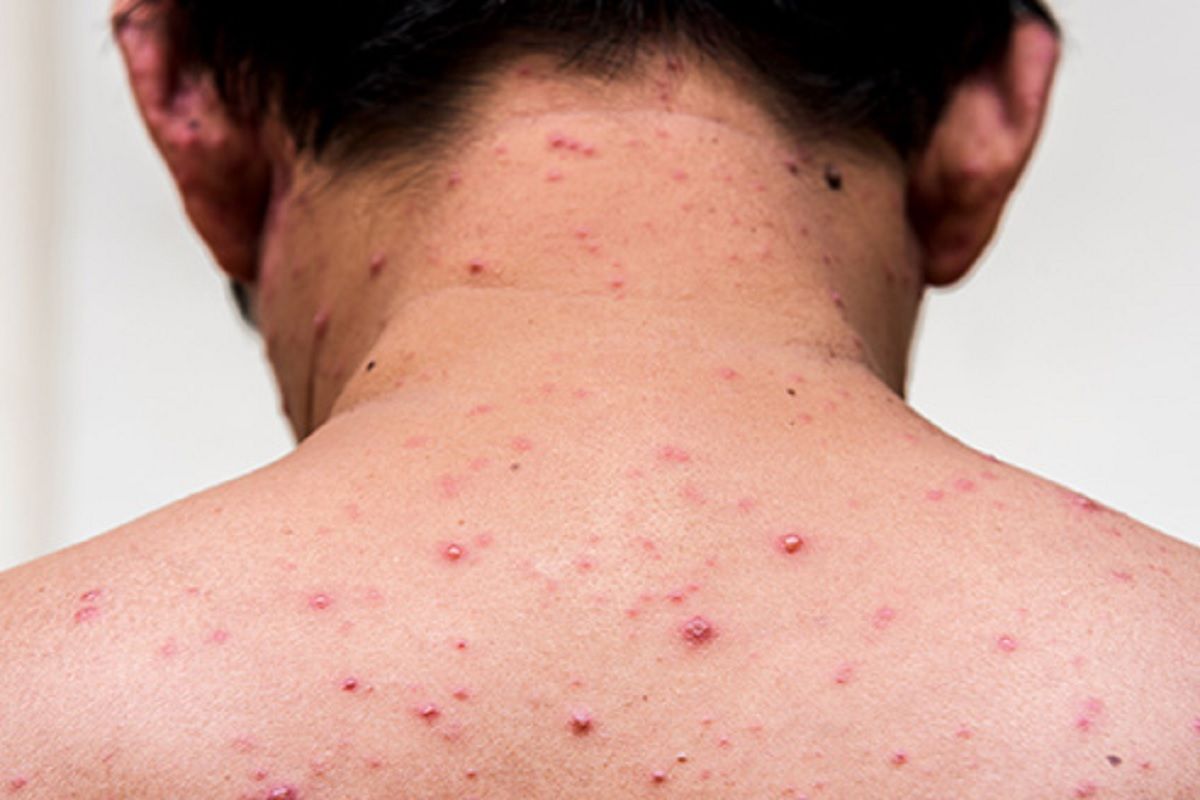 Measles Symptoms: गोवरची लागण कशामुळे होते? जाणून घ्या कारण आणि लक्षणं...