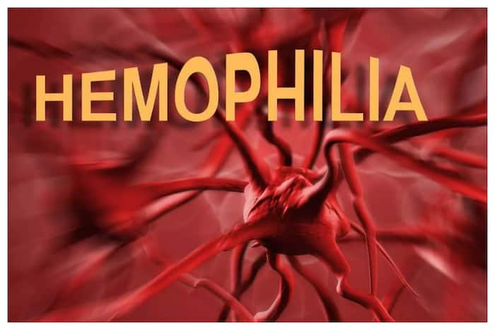 Worlds Most Expensive Medicine Cost Of One Dose Will Stun You Useful In ...