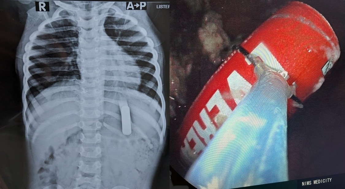 Toddler Swallows TV Remote Battery, Lands in Hospital