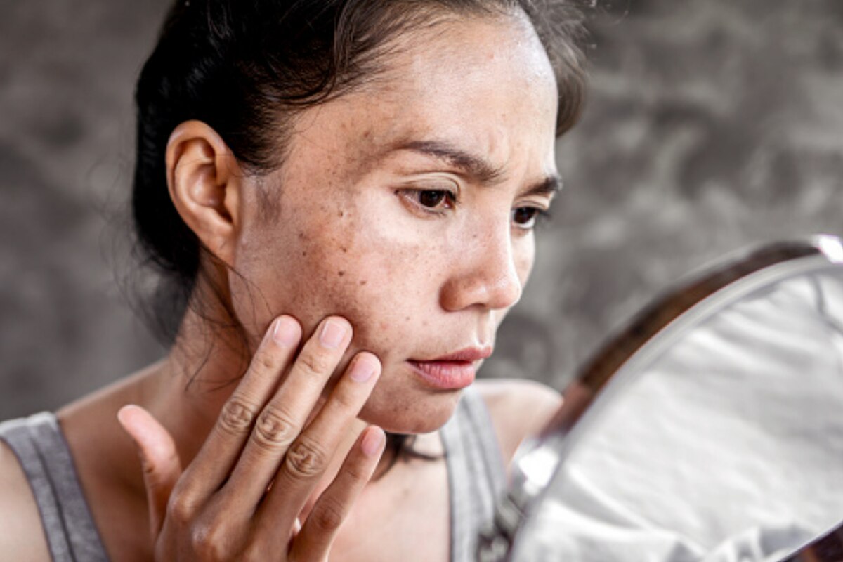 Dark Spots Causes And Treatment 6 Ways To Treat Hyperpigmentation On Skin Dark Spots Causes And Treatment 6 Ways To Treat Hyperpigmentation On Skin