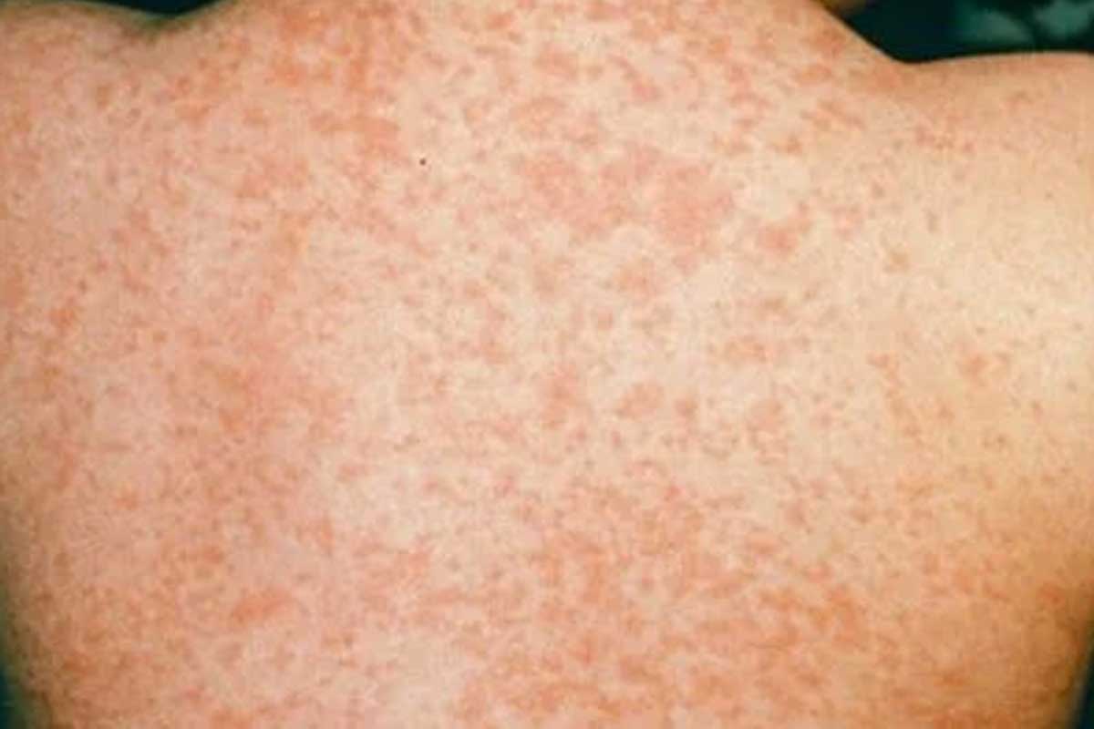 इन राज्यों में तेजी से बढ़ रहे खसरे के मामले, केंद्र ने राज्यों को इन ...