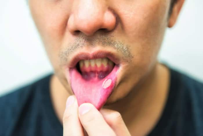 Mouth Ulcers: 7 Home Remedies to Treat Sores Inside Your Mouth