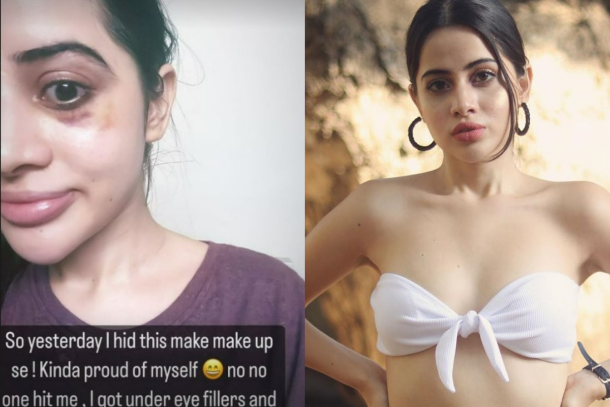 Urfi Javed Shows Her Bruised Face, Opens Up on Under-Eye Filler Gone Wrong