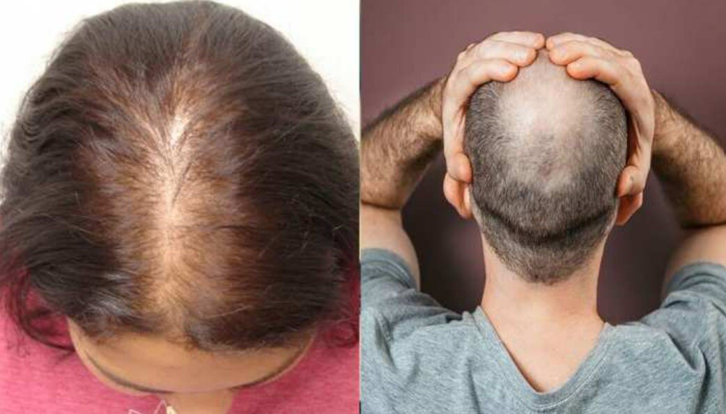 Jhadte Balo ka Ilaaj: सर्दियों में झड़ते बाल कर रहे परेशान, चिंता न ...