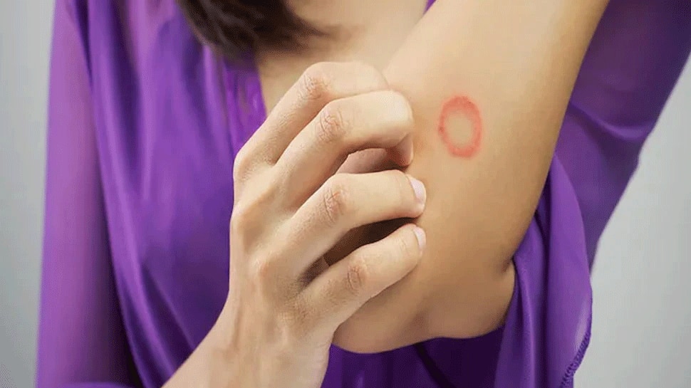 दाद, खाज, खुजली से हैं परेशान...अनार के पत्ते पीस कर लगाएं ringworm ...