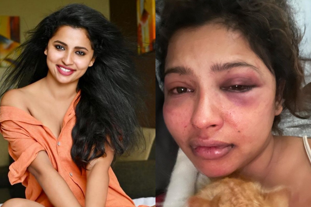 सूजी हुई आंख और चोट के निशान के साथ एक्ट्रेस ने शेयर की तस्वीर ...