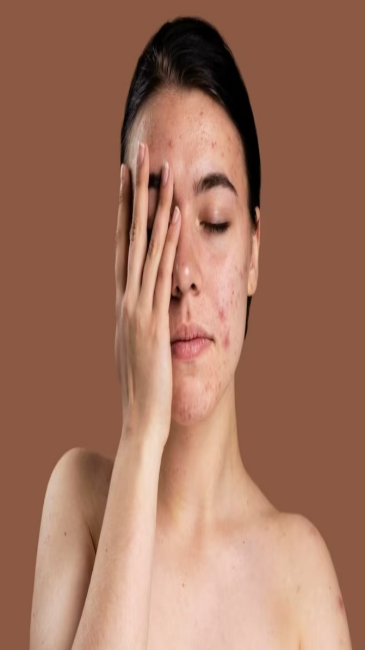 Monsoon Skin Care: 8 Tips to Prevent Acne